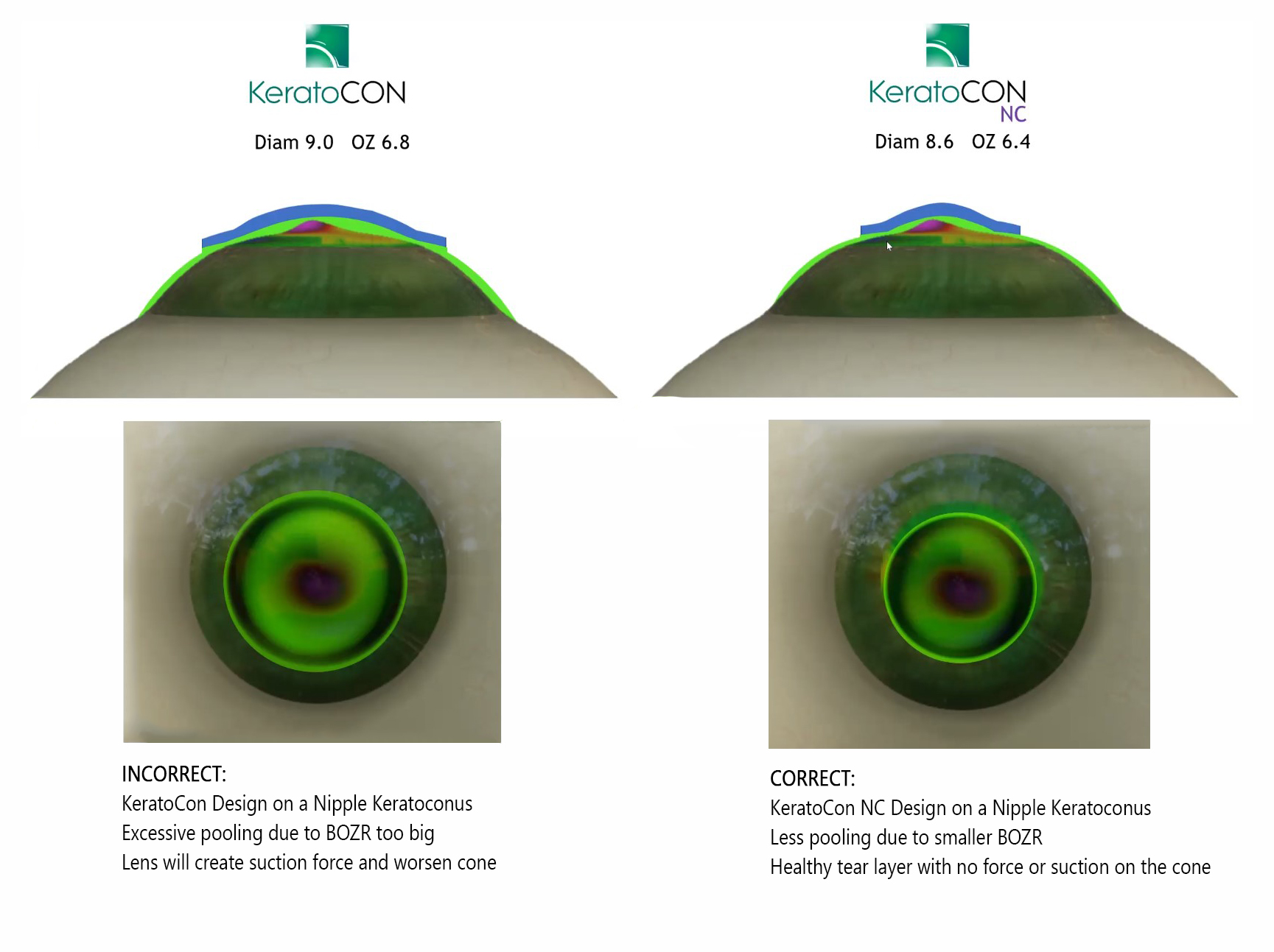 Keratoconus - InnoCon