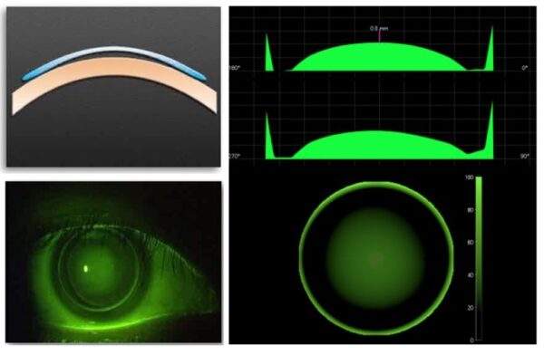 Central Zone - Back Optic Zone Radius - InnoCon